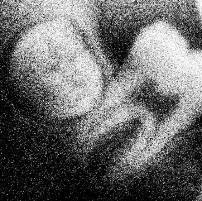 Wisdom Teeth | South Yarra Dental Group